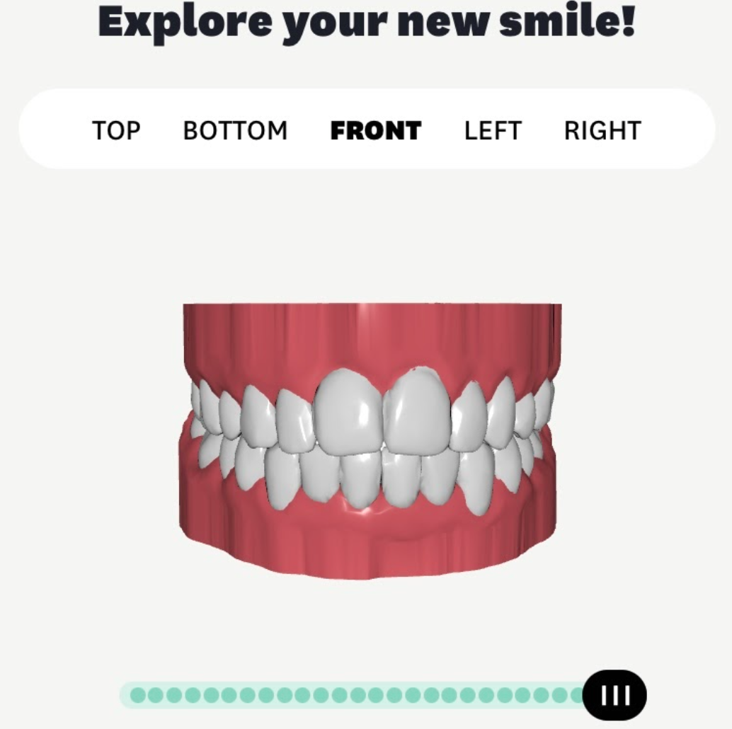 First Bite: Starting My Journey With Byte Clear Aligners